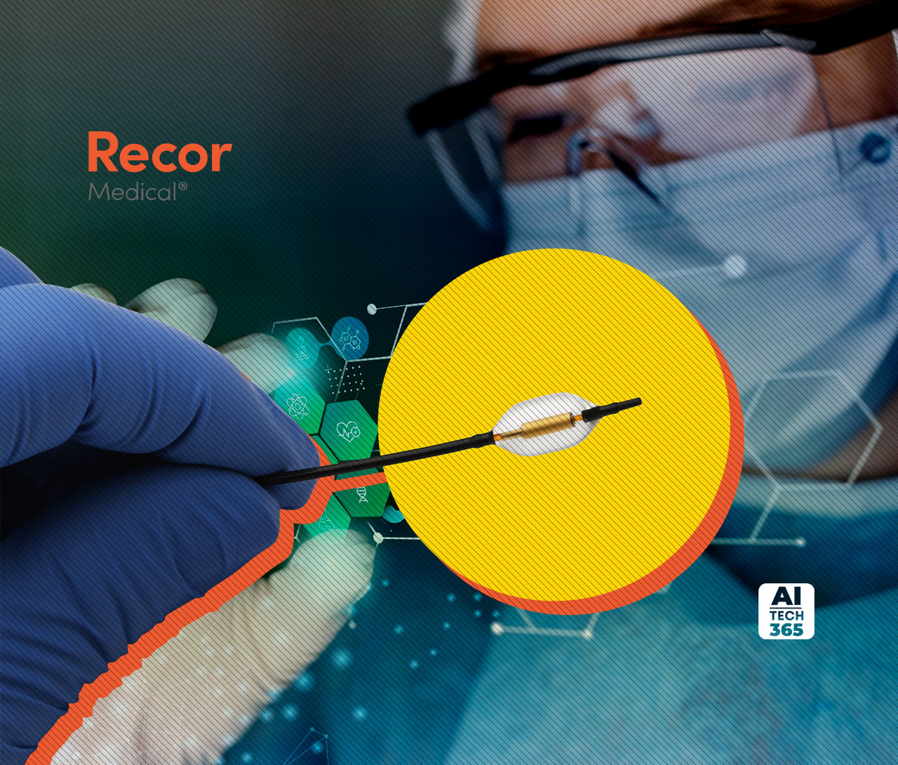 Recor Medical Announces U.S. Launch and First Commercial Cases of Paradise Ultrasound Renal ...